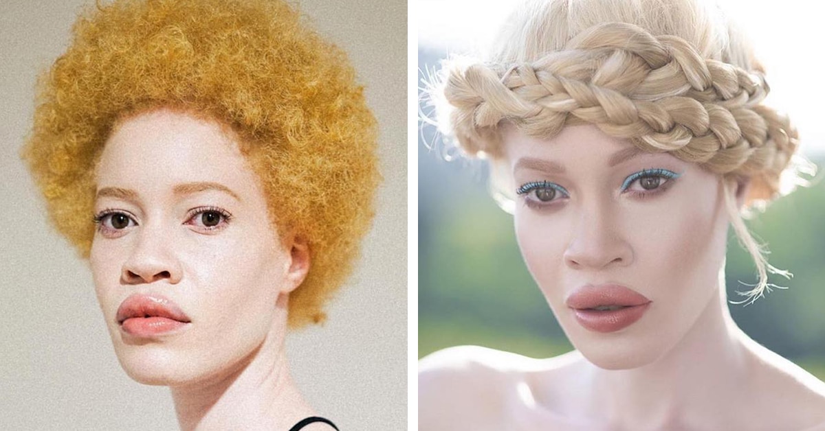 African-American Model with Albinism Breaks Barriers to Expand the ...